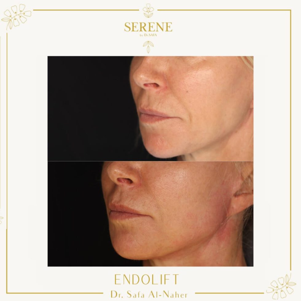 Endolift In London | Non-Surgical Facelift | Endolift before and after