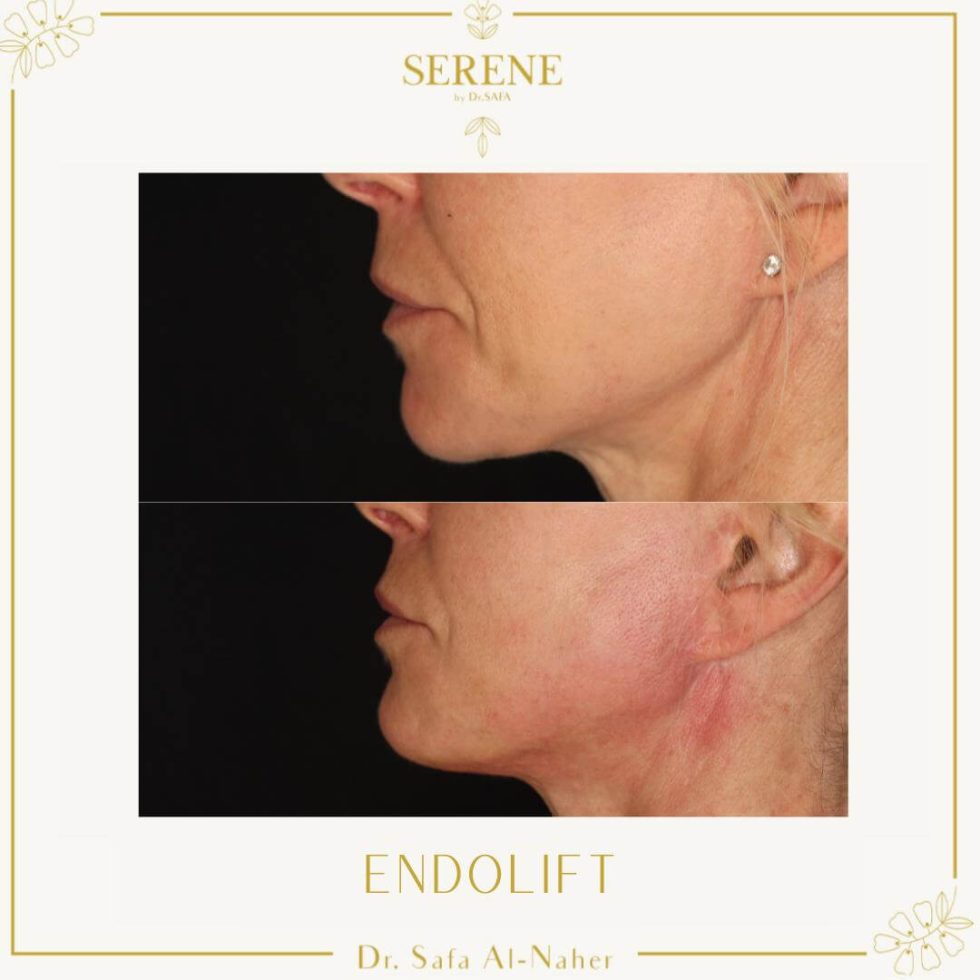 Endolift In London | Non-Surgical Facelift | Endolift before and after