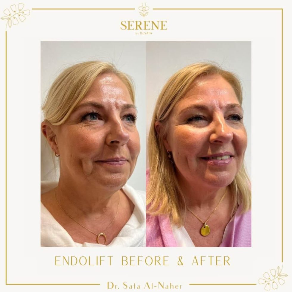 Endolift In London | Non-Surgical Facelift | Endolift before and after